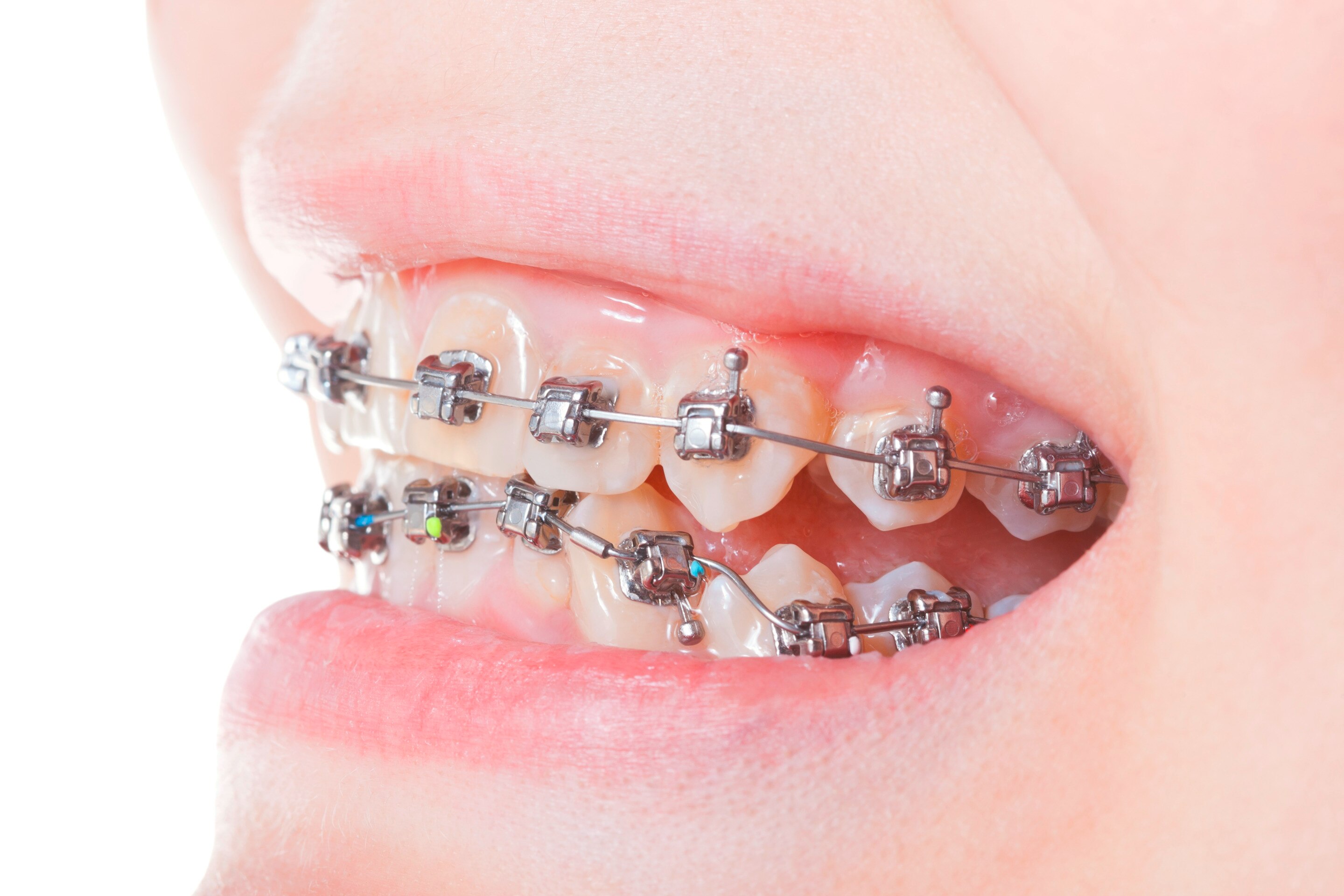 Different Types of Dental Braces and How They Work | AllThingsBeauty